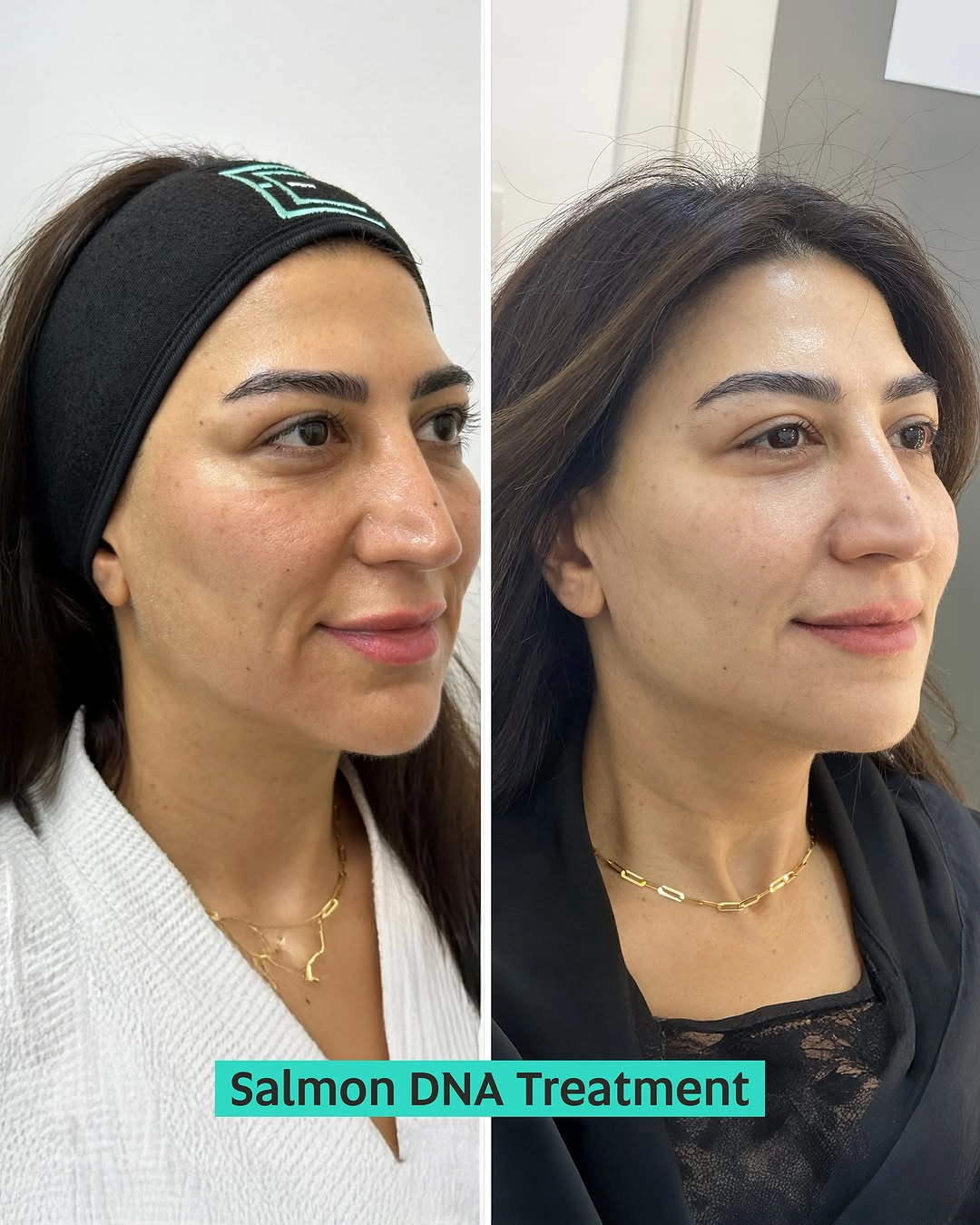 #1 Revolutionary Salmon DNA Treatment in Dubai | Estelaza Clinic