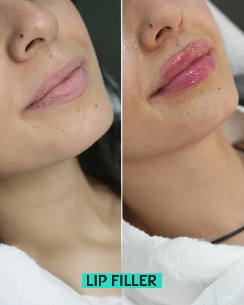 Lip Fillers Dubai | 1st Expert Natural Results - Estelaza