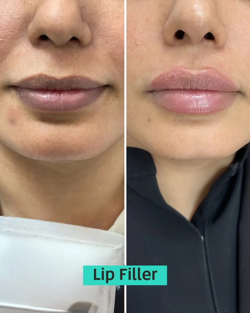 Lip Fillers Dubai | 1st Expert Natural Results - Estelaza