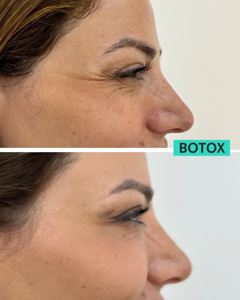Botox Dubai | Anti-Wrinkle Injections - Estelaza Clinic