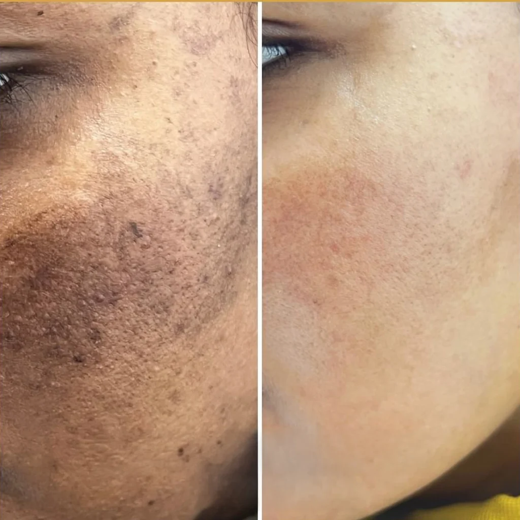 #1 Effective Melasma Treatment in Dubai for Clear Skin | Estelaza ...