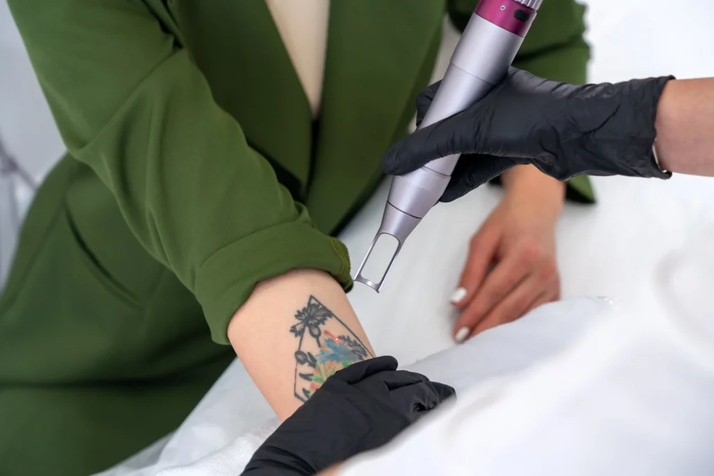 #1 Advanced Tattoo Removal Dubai | Estelaza Clinic Laser Treatment
